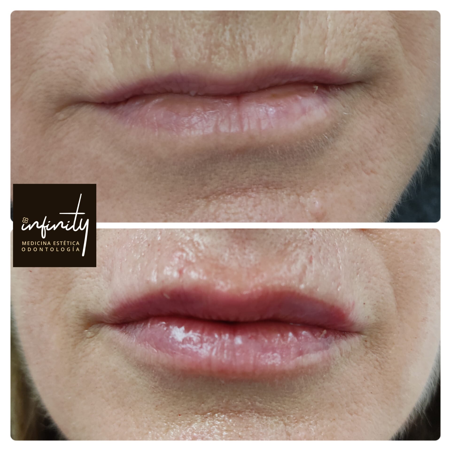 Hidratación de Labios - Clinicas Infinity